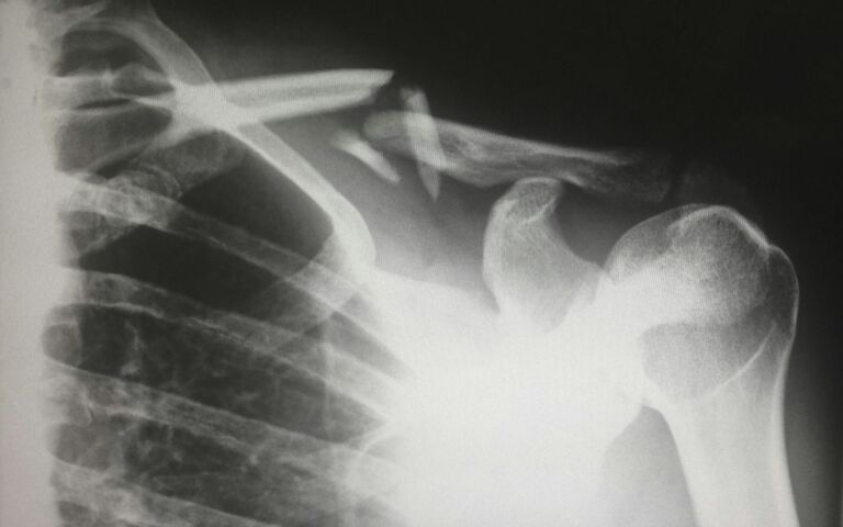 Osteoporotic fractures (bone fractures in old age) – USZ